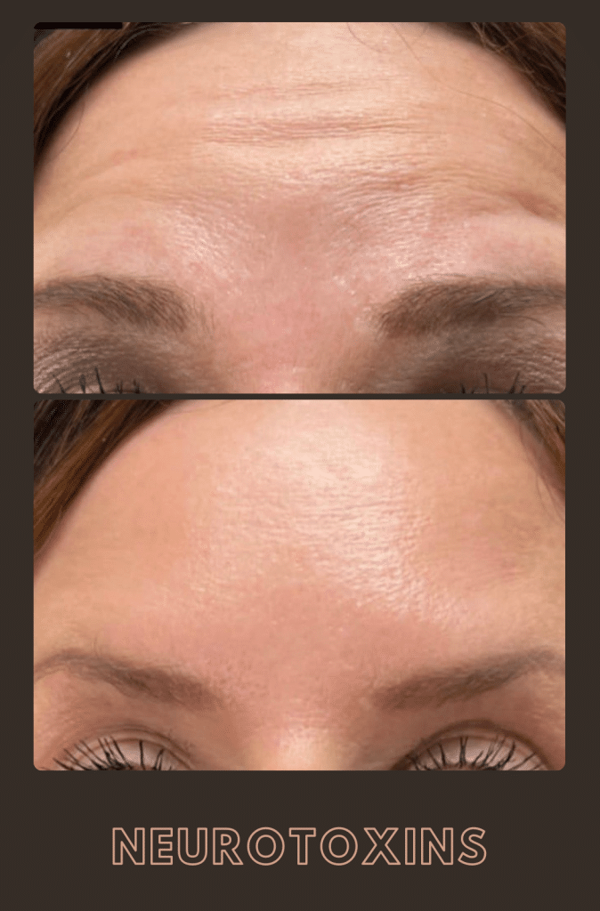 Neurotoxins – Belle Ame Med Spa