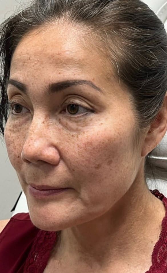 Fillers Image Gallery - Belle Âme Med Spa